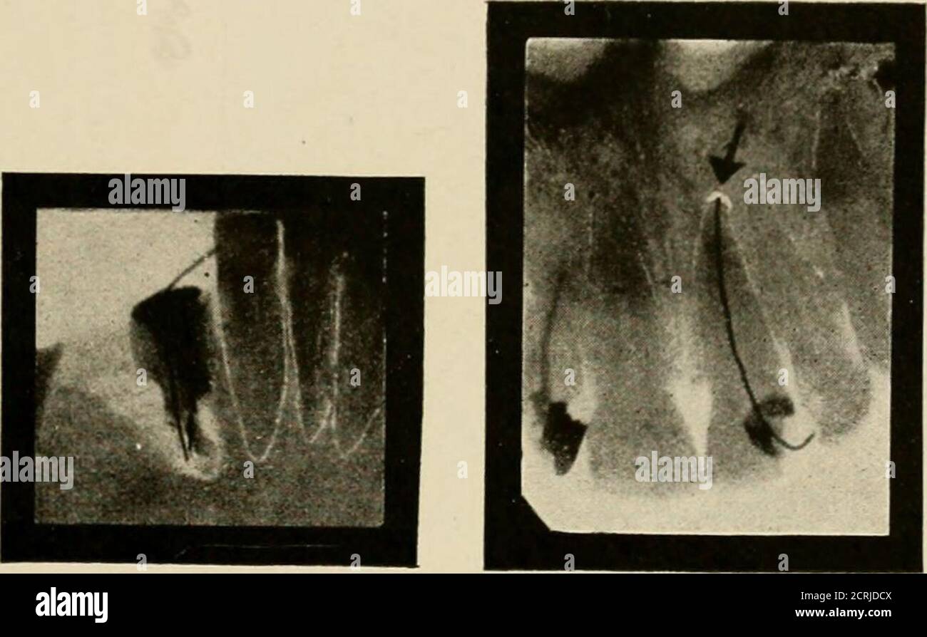 . Elementary and dental radiography / by Howard Riley Raper . Fig. 193 ...