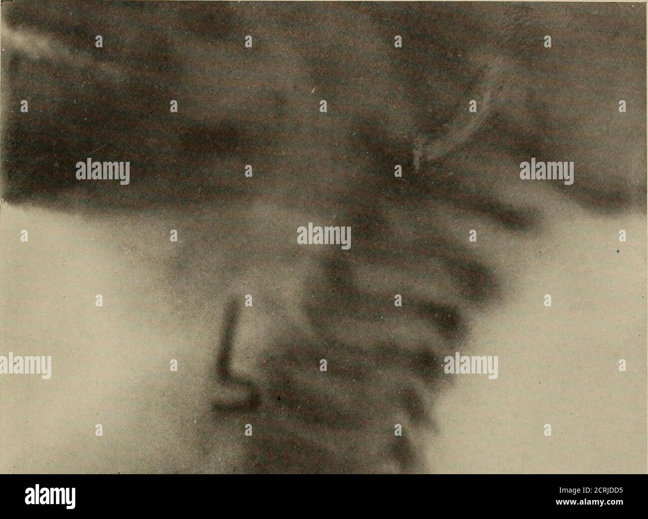 . Living anatomy and pathology; . —ii PLATE 146.HOOK IN THE LARYNX ...
