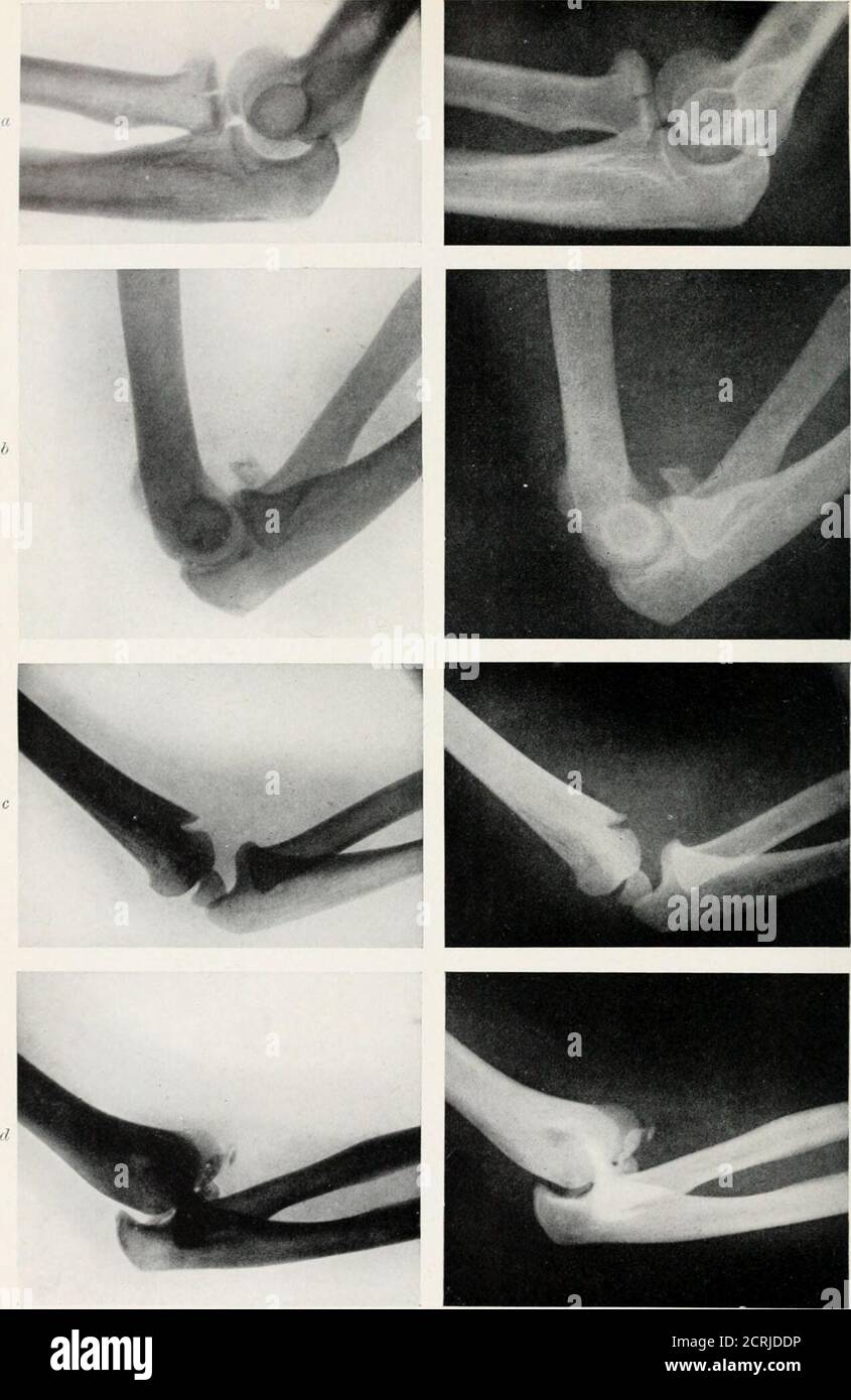 Upper arm x ray hi-res stock photography and images - Alamy