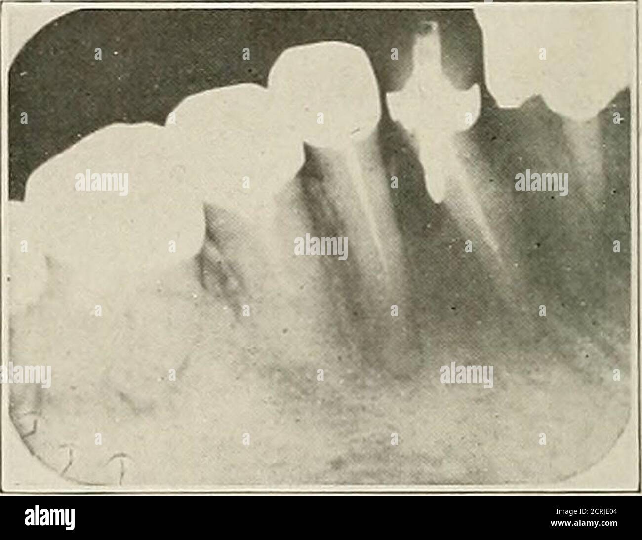 . Interpretation of dental and maxillary roentgenograms . Fig. 196. Fig ...
