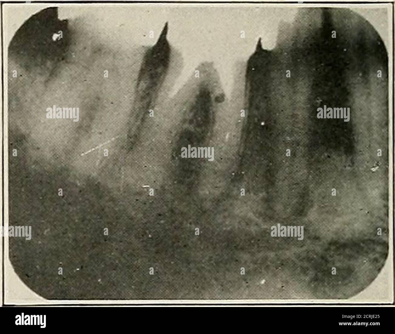 . Interpretation of dental and maxillary roentgenograms . Fig. 194. Fig ...