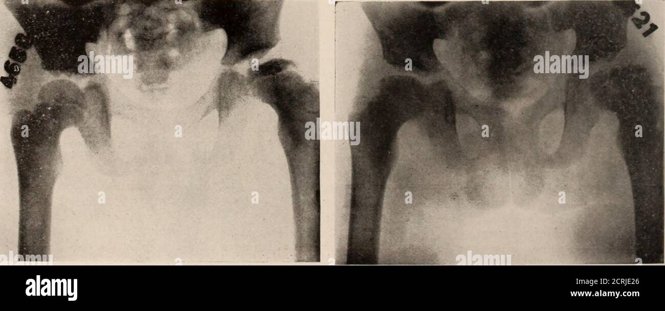 Atrophy femur hi-res stock photography and images - Alamy
