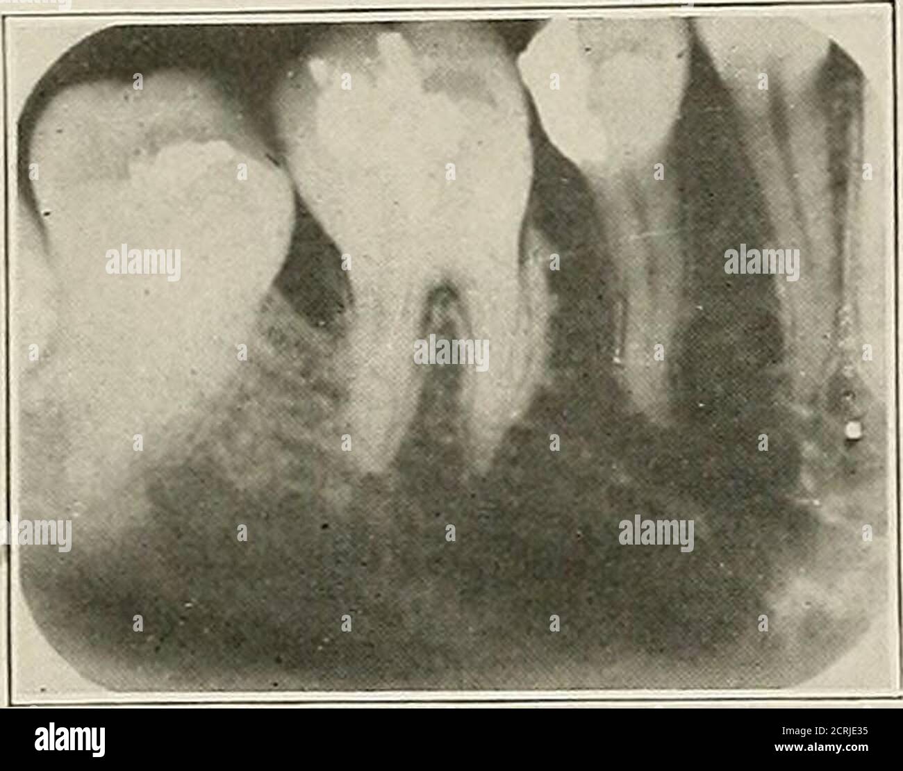 . Interpretation of dental and maxillary roentgenograms . Fig. 192. Fig ...