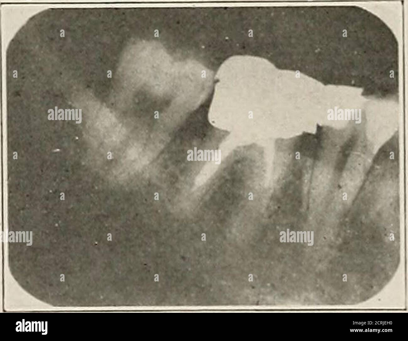 . Interpretation of dental and maxillary roentgenograms . Fig. 192. Fig ...