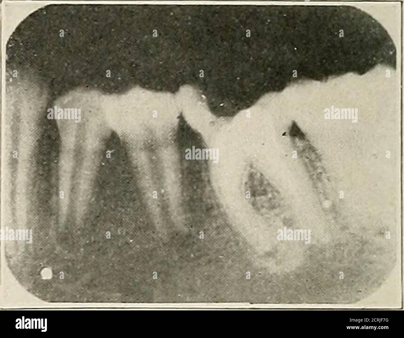 . Interpretation of dental and maxillary roentgenograms . Fig. 186. Fig ...