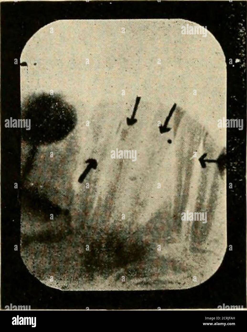 . Elementary and dental radiography / by Howard Riley Raper . Fig. 176 ...