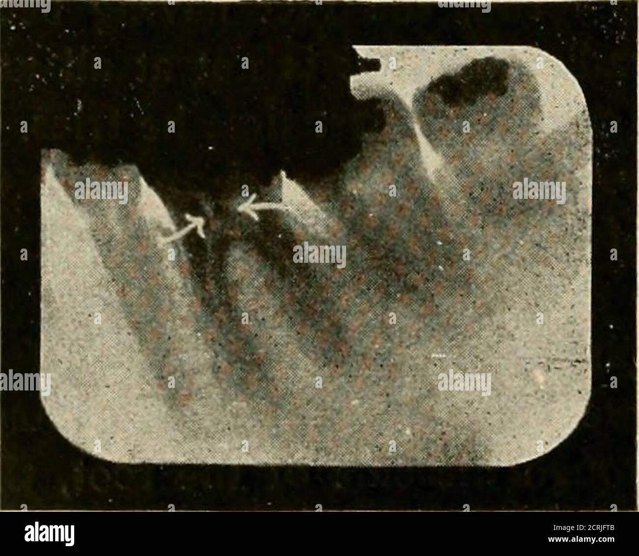 . Elementary and dental radiography / by Howard Riley Raper . Fig. 175 ...