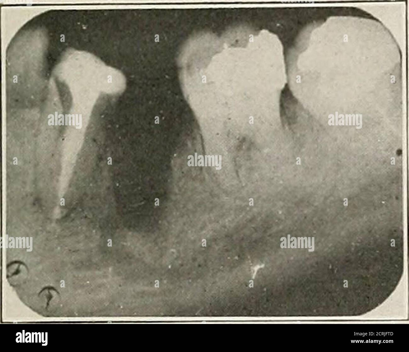 . Interpretation of dental and maxillary roentgenograms . Fig. 180. Fig ...