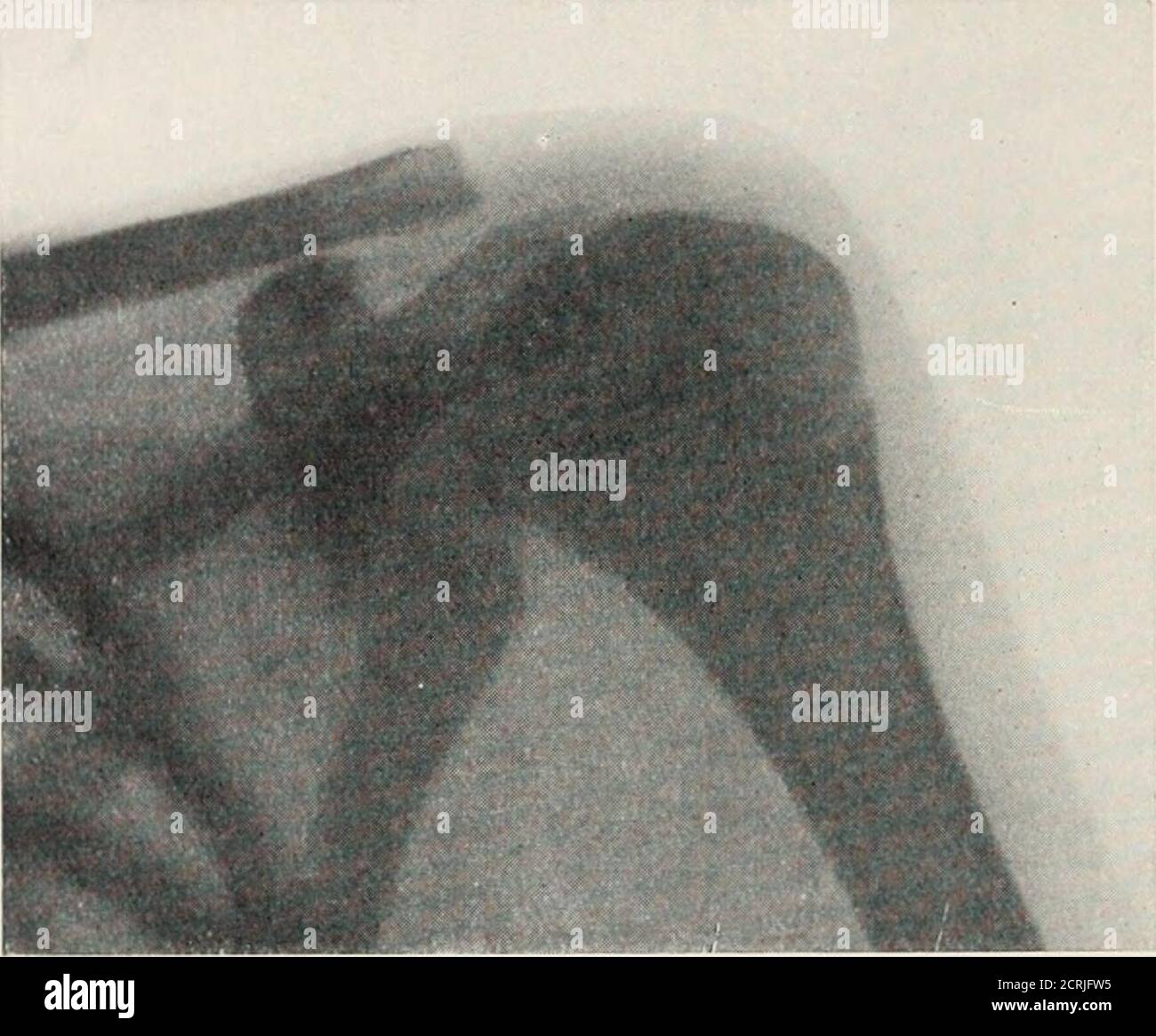 Normal shoulder x ray hi-res stock photography and images - Alamy