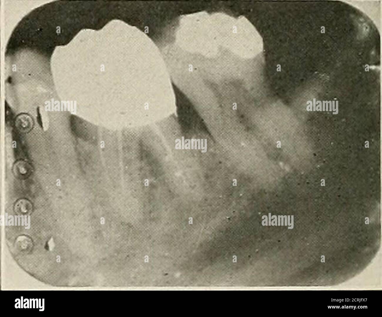 . Interpretation of dental and maxillary roentgenograms . Fig. 178. Fig ...