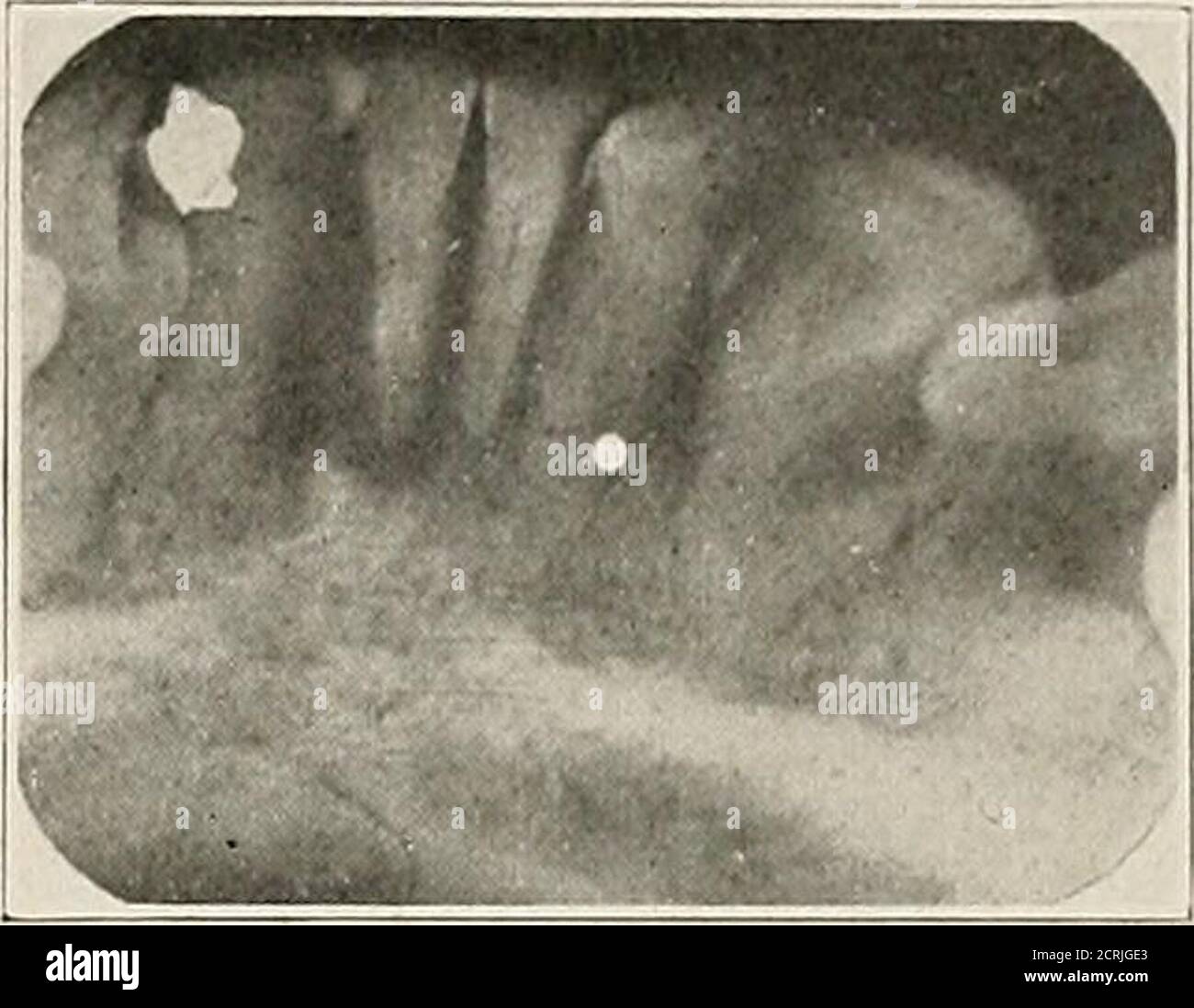 . Interpretation of dental and maxillary roentgenograms . Fig. 174. Fig ...