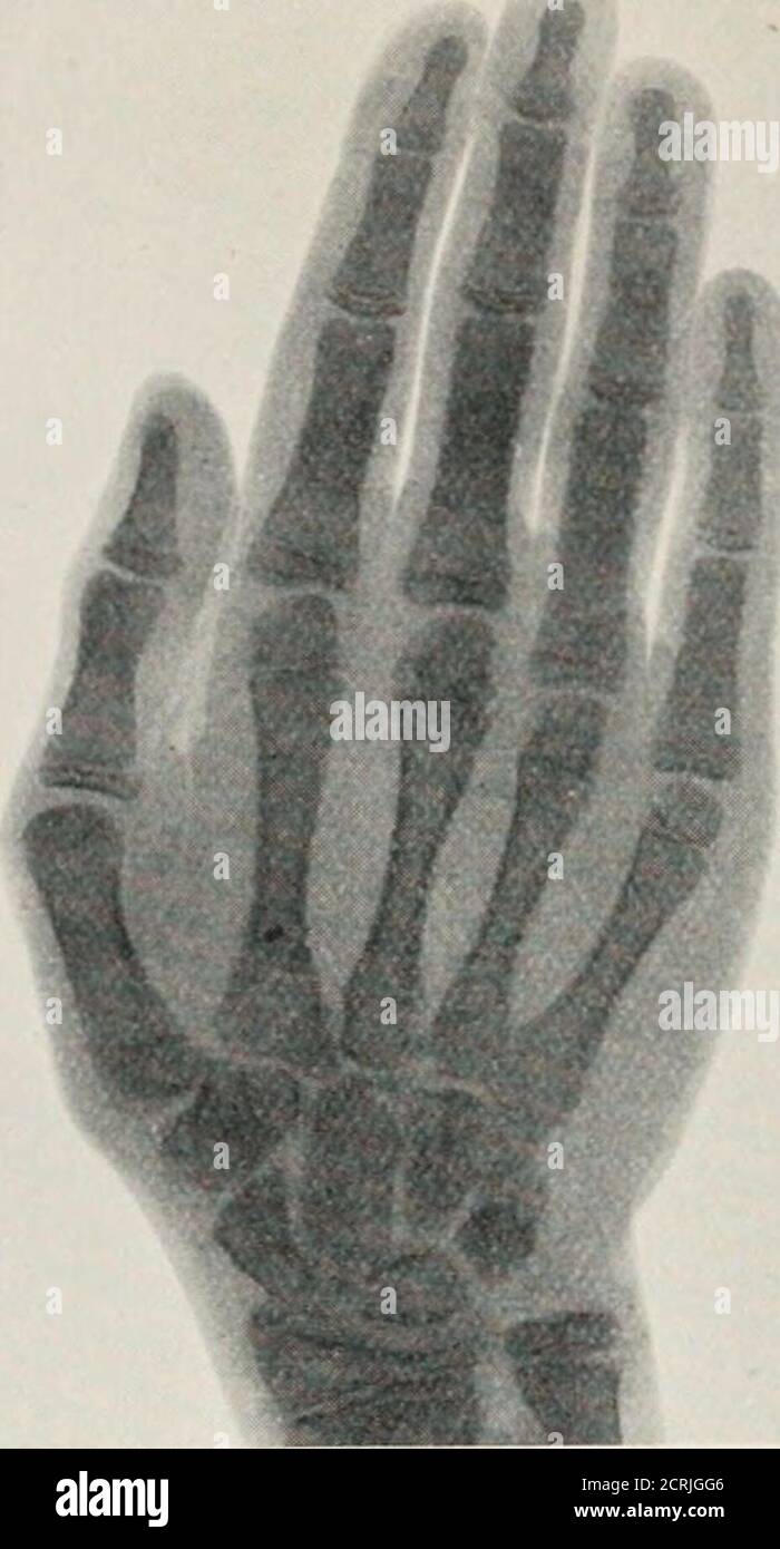 . Radiography, X-ray therapeutics and radium therapy . Fig. 121.—Hand ...