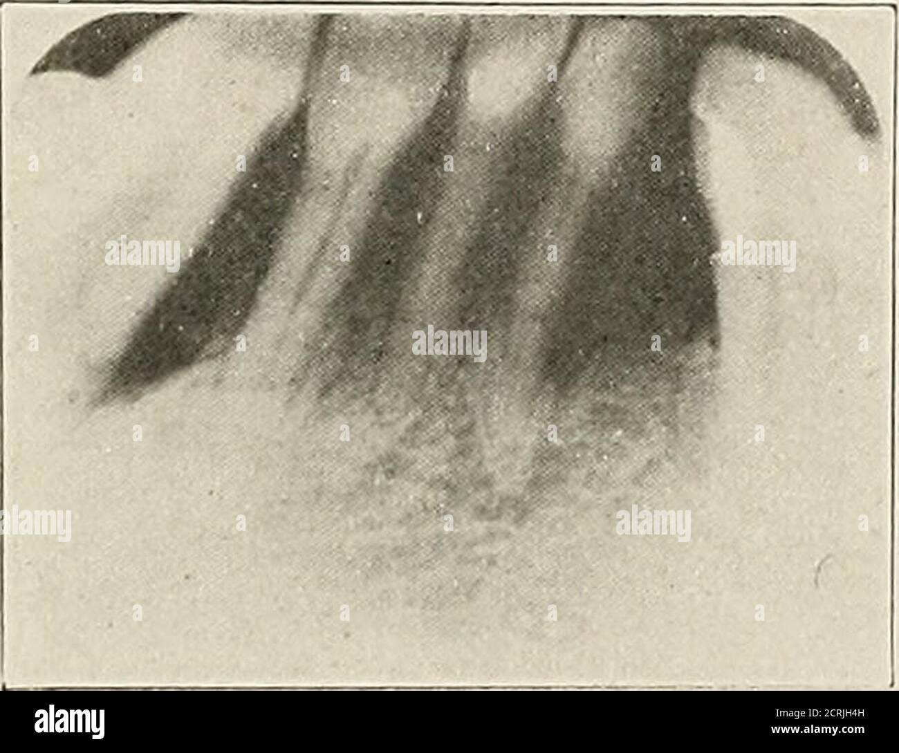 . Interpretation of dental and maxillary roentgenograms . Fig. 170. Fig ...