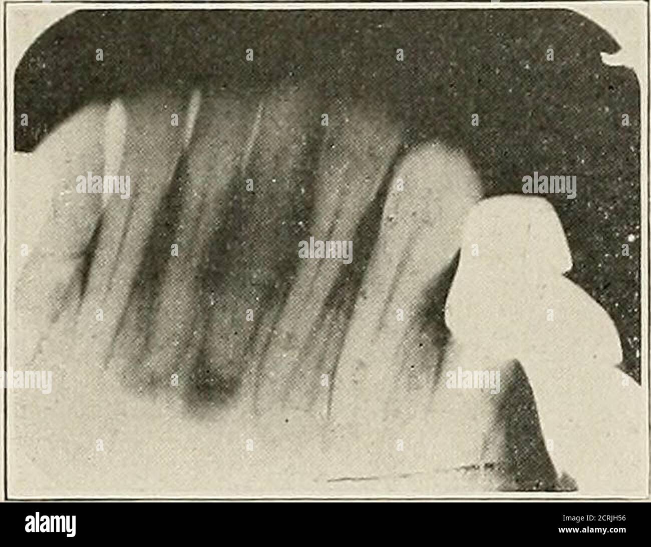 . Interpretation of dental and maxillary roentgenograms . Fig. 168. Fig ...