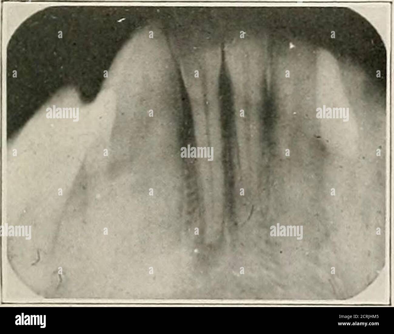 . Interpretation of dental and maxillary roentgenograms . Fig. 166. Fig ...