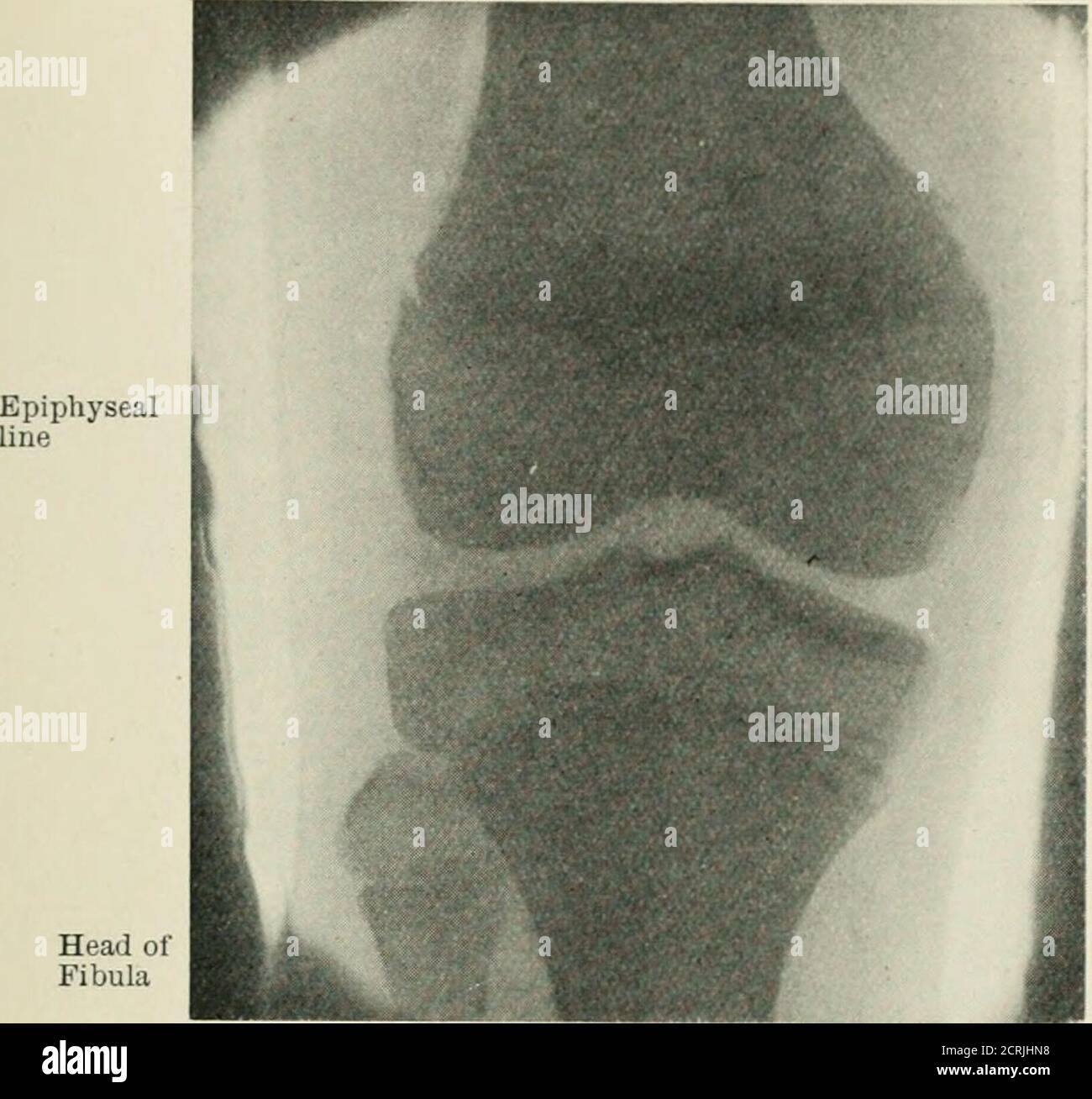 Epiphyseal plate hi-res stock photography and images - Alamy