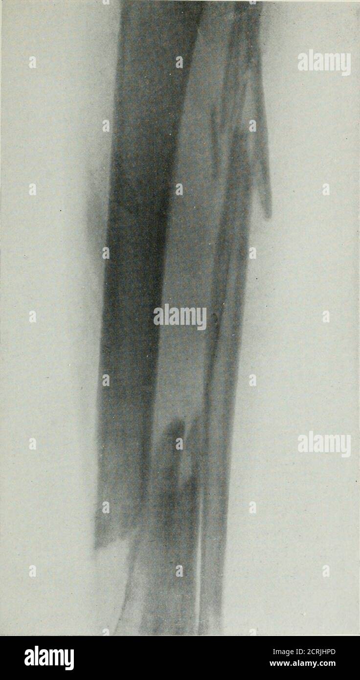 Longitudinal tibia hi-res stock photography and images - Alamy