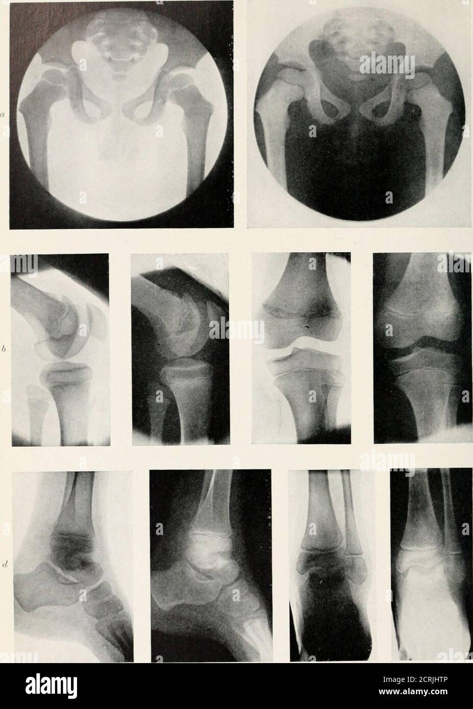 Epiphyses of the femur hi-res stock photography and images - Alamy