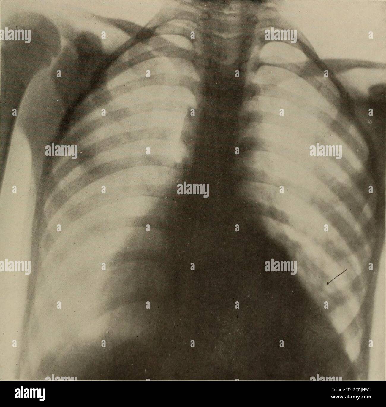 Empyema High Resolution Stock Photography and Images - Alamy