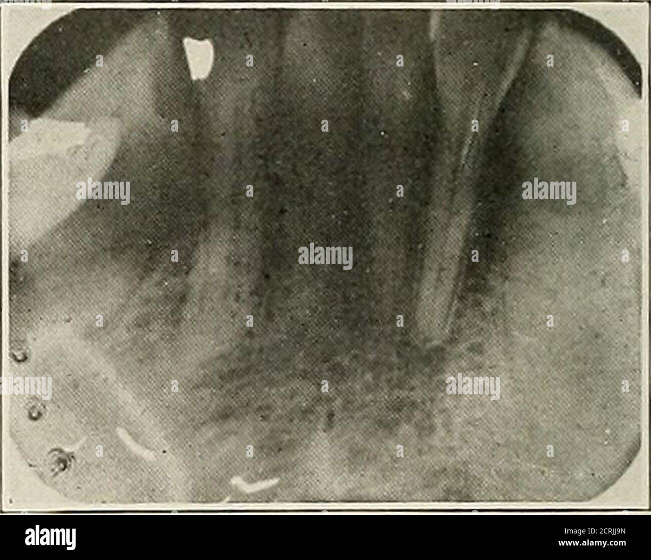 . Interpretation of dental and maxillary roentgenograms . Fig. 162. Fig ...