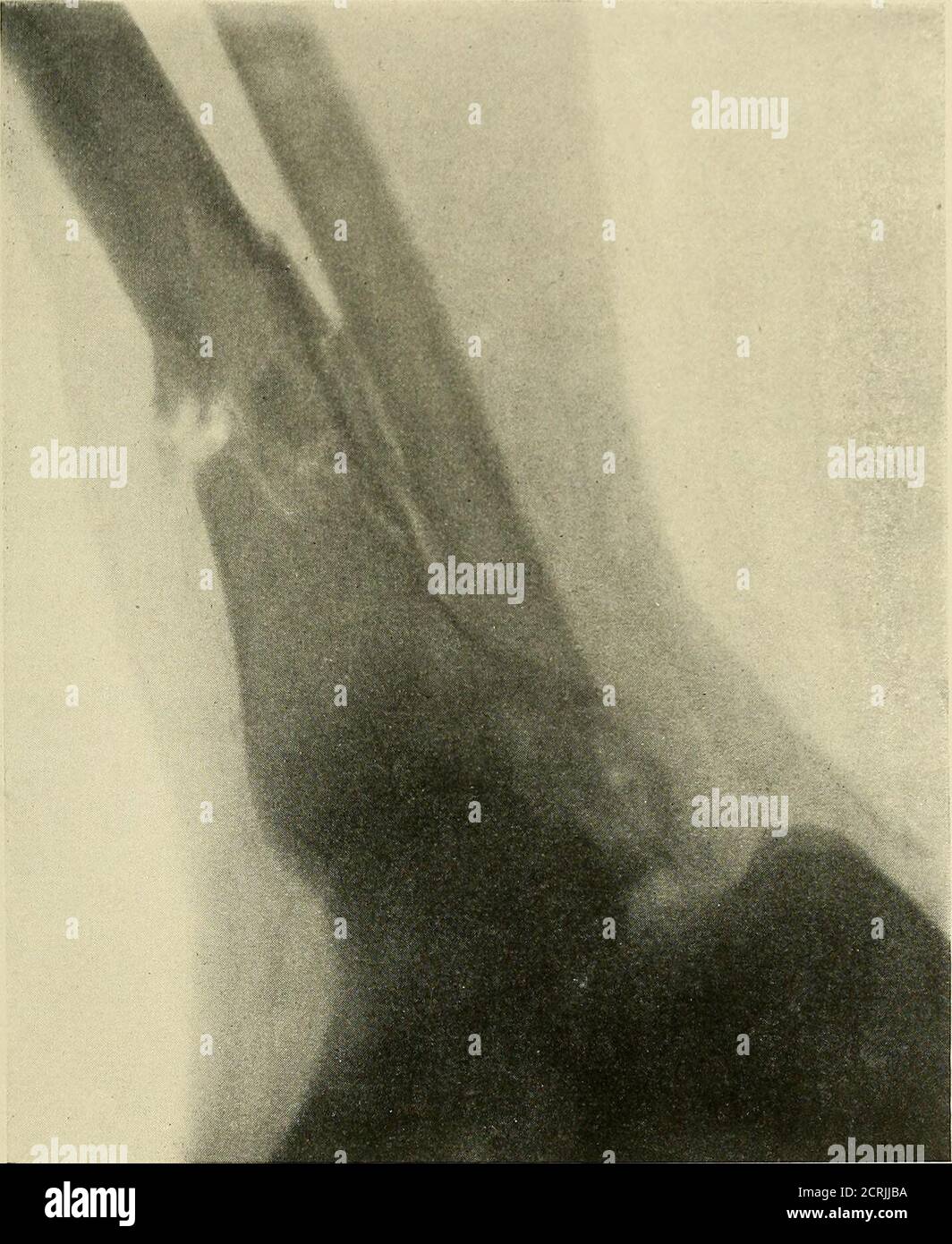 . Röntgen ray diagnosis and therapy . Fig. 255.—Multiple Fracture of ...