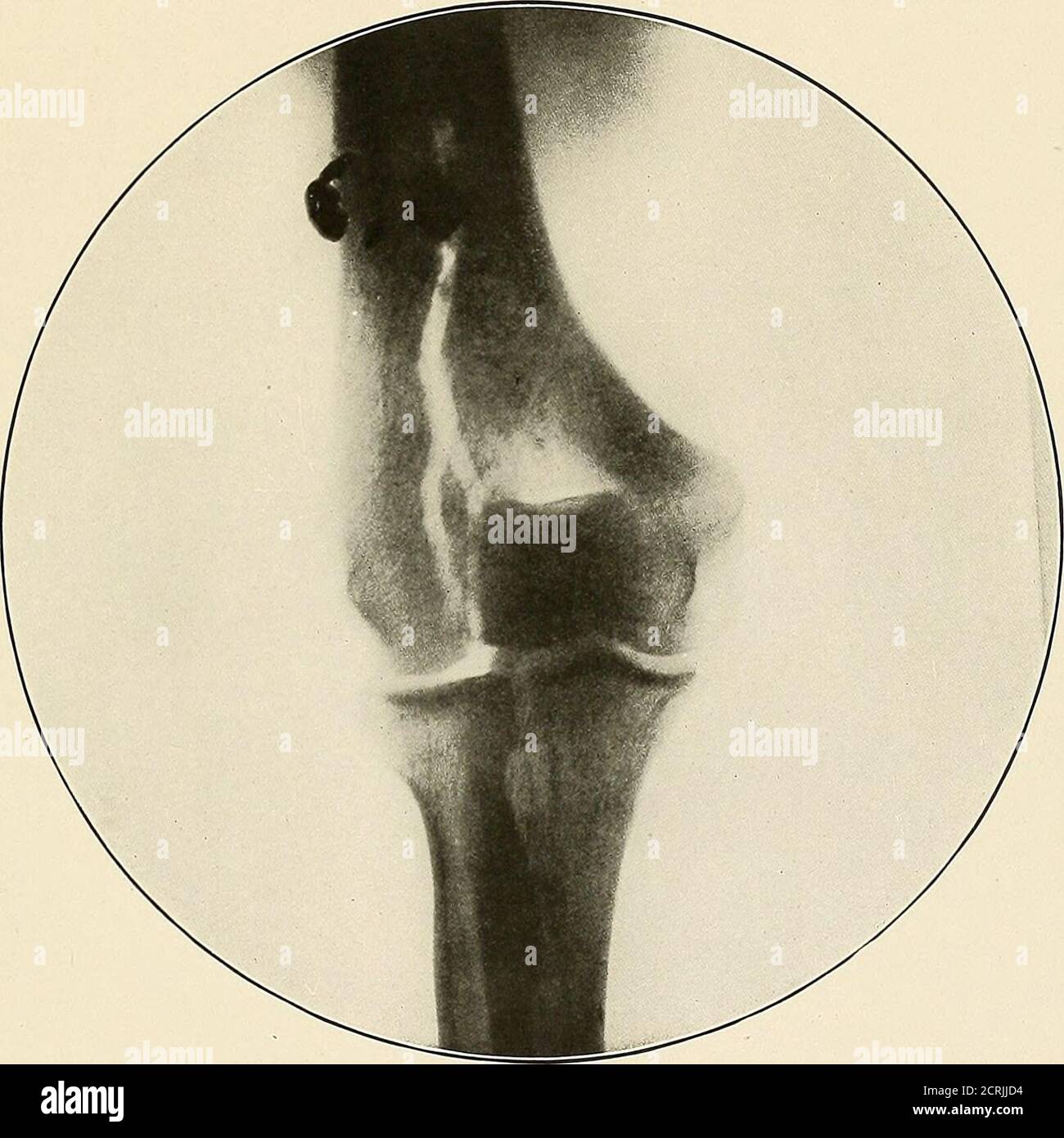 . A radiographic atlas of the pathologic changes of bones and joints ...
