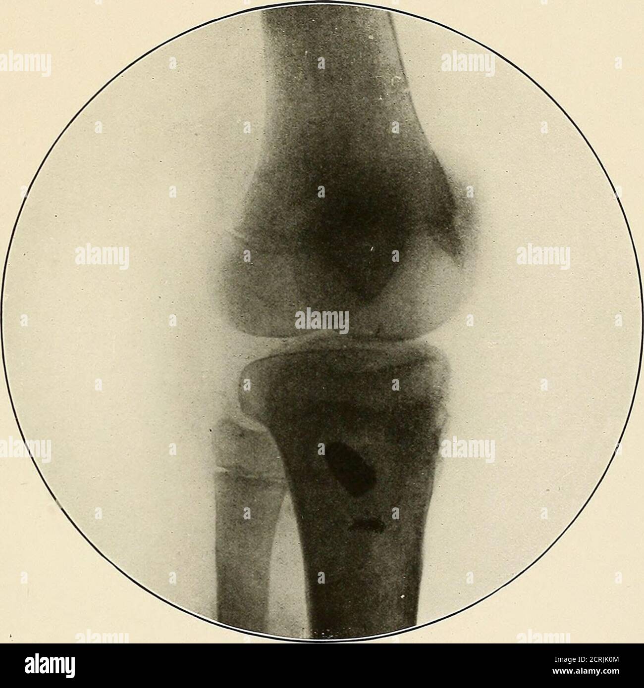 . A radiographic atlas of the pathologic changes of bones and joints ...