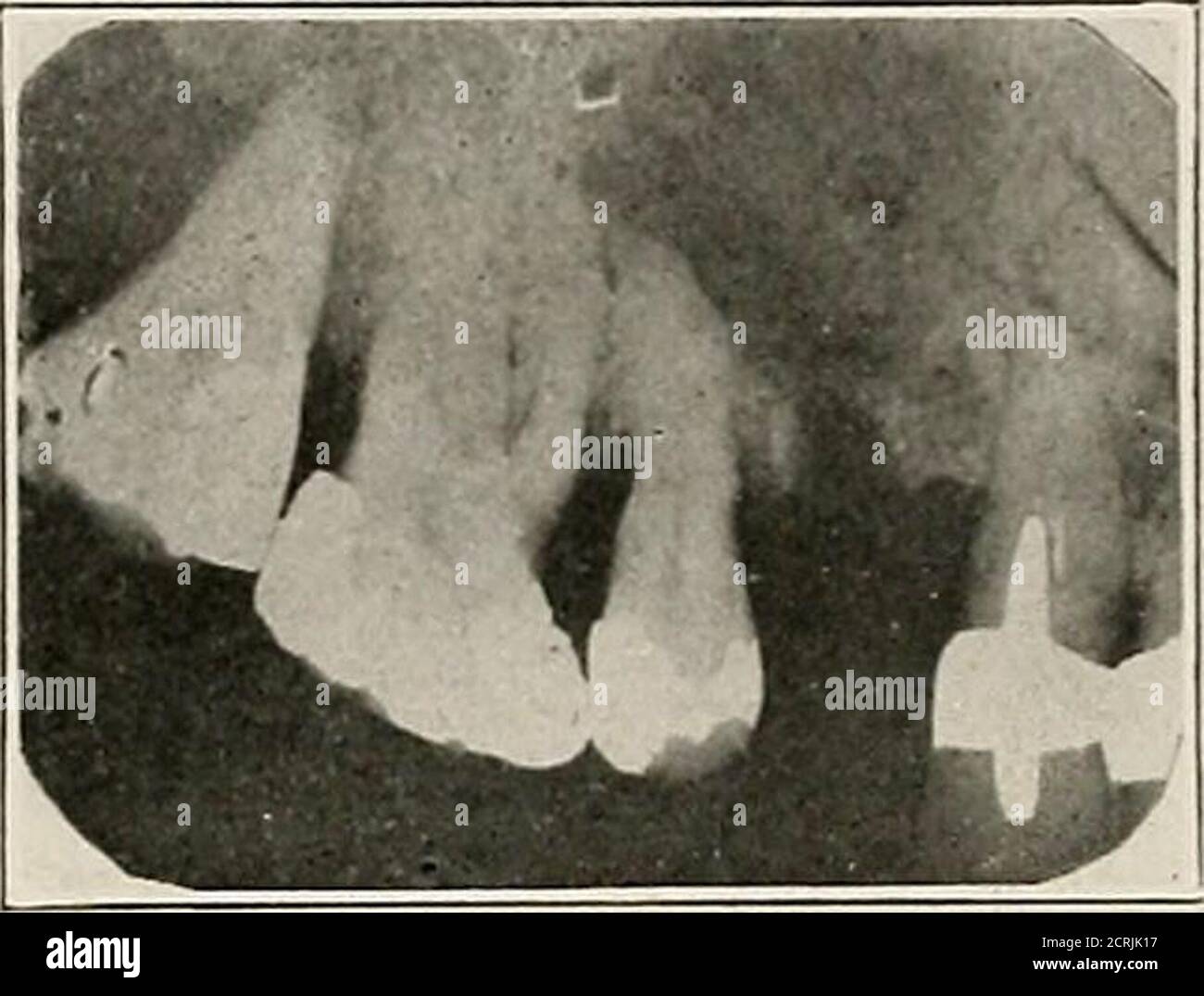 . Interpretation of dental and maxillary roentgenograms . Fig. 158. Fig ...