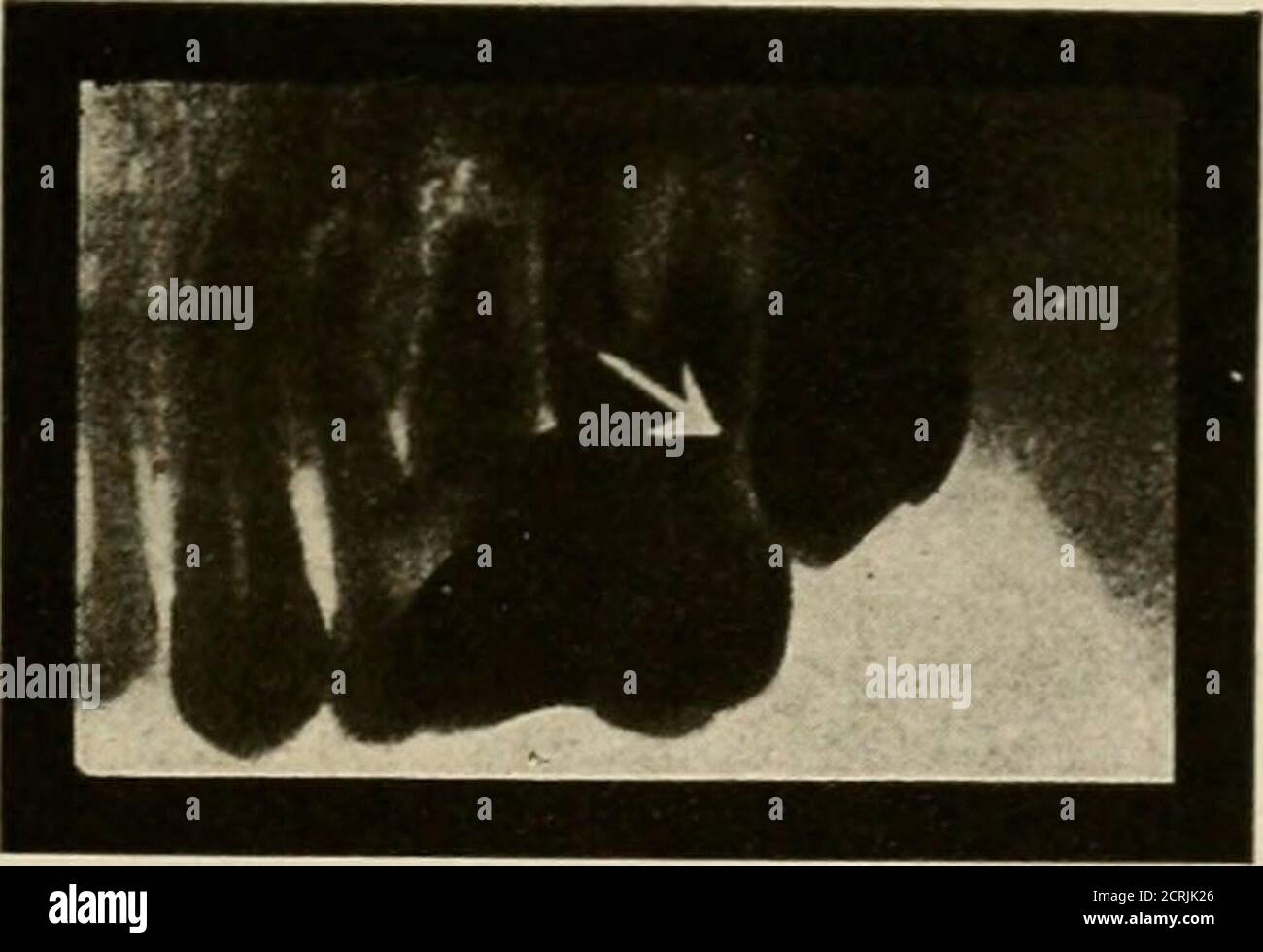 . Elementary and dental radiography / by Howard Riley Raper . Fig. 157 ...