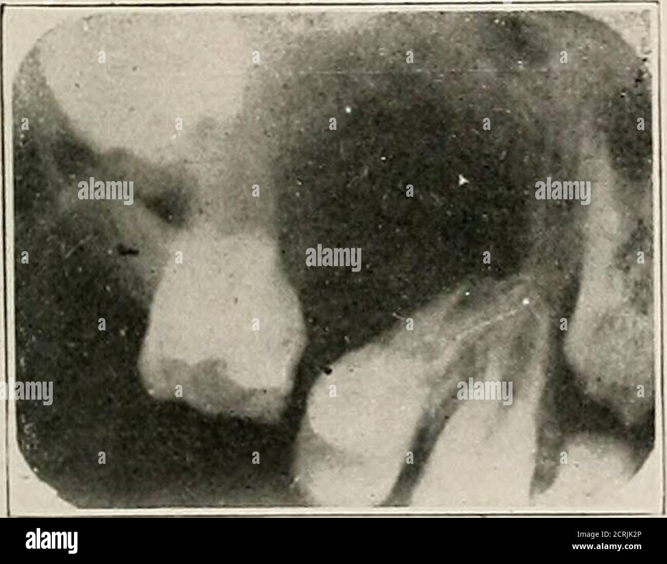 . Interpretation of dental and maxillary roentgenograms . Fig. 158. Fig ...