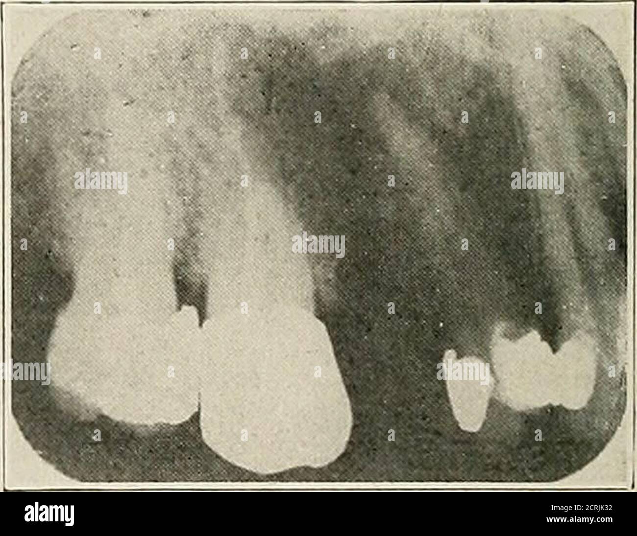 . Interpretation of dental and maxillary roentgenograms . Fi.^. 156 ...