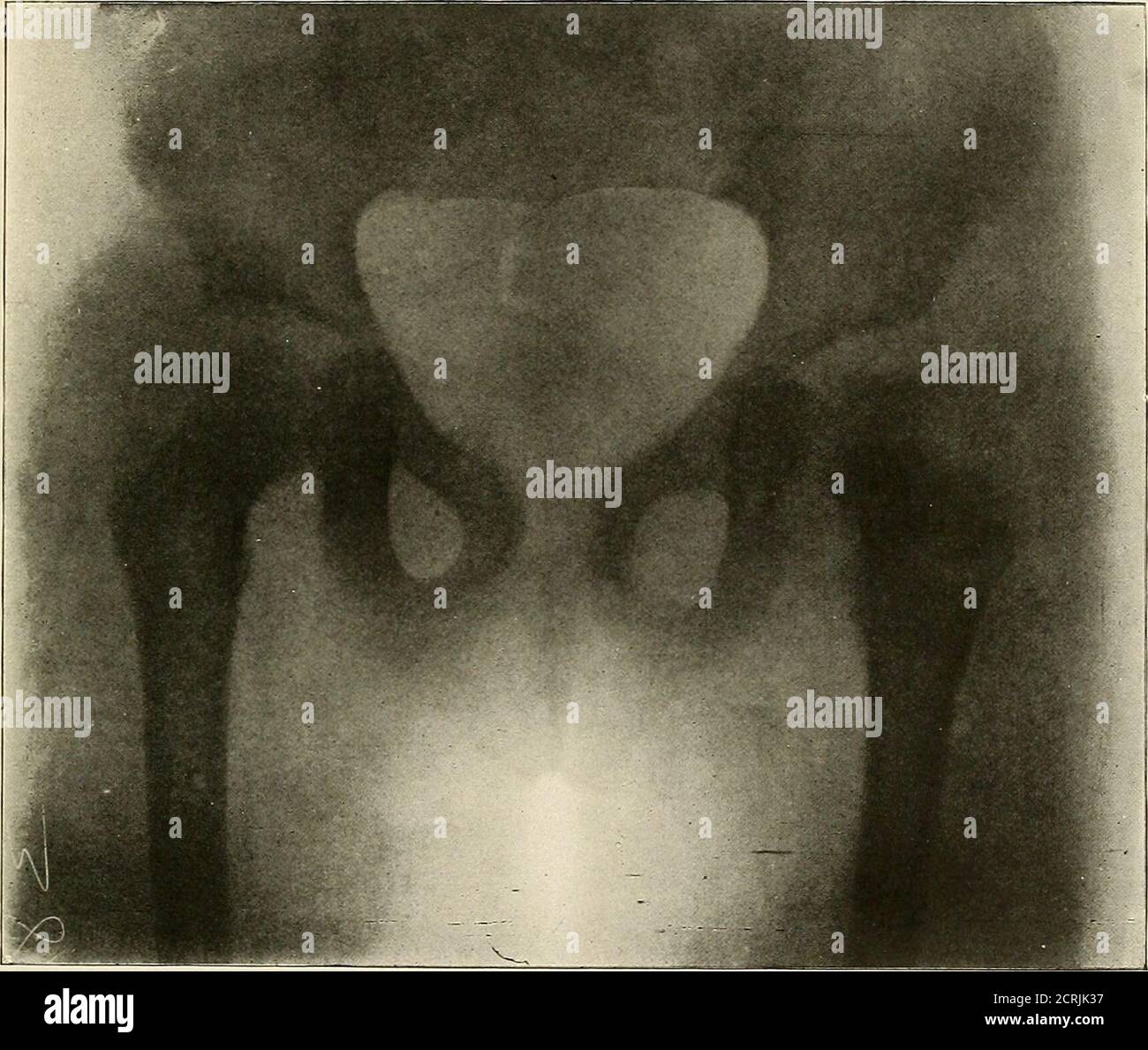 Acetabular cavity hi-res stock photography and images - Alamy