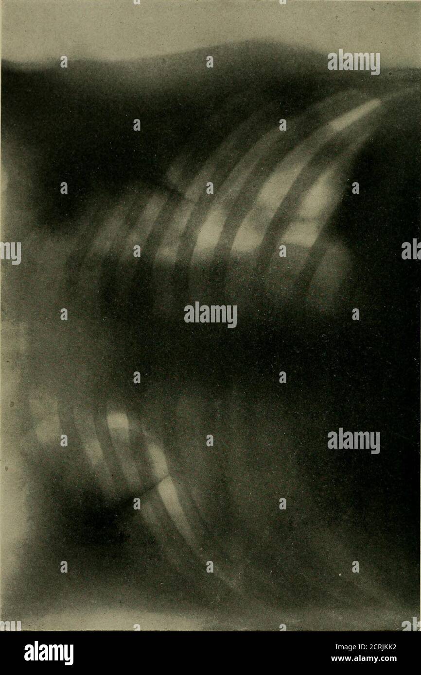 Swallowed x ray hi-res stock photography and images - Alamy