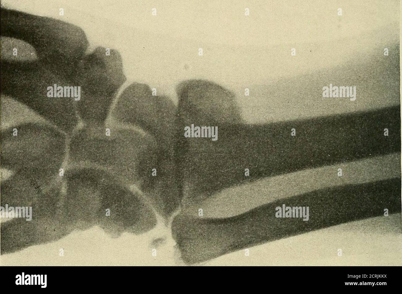 . Röntgen ray diagnosis and therapy . Fig. 247.—Transverse Fracture of ...