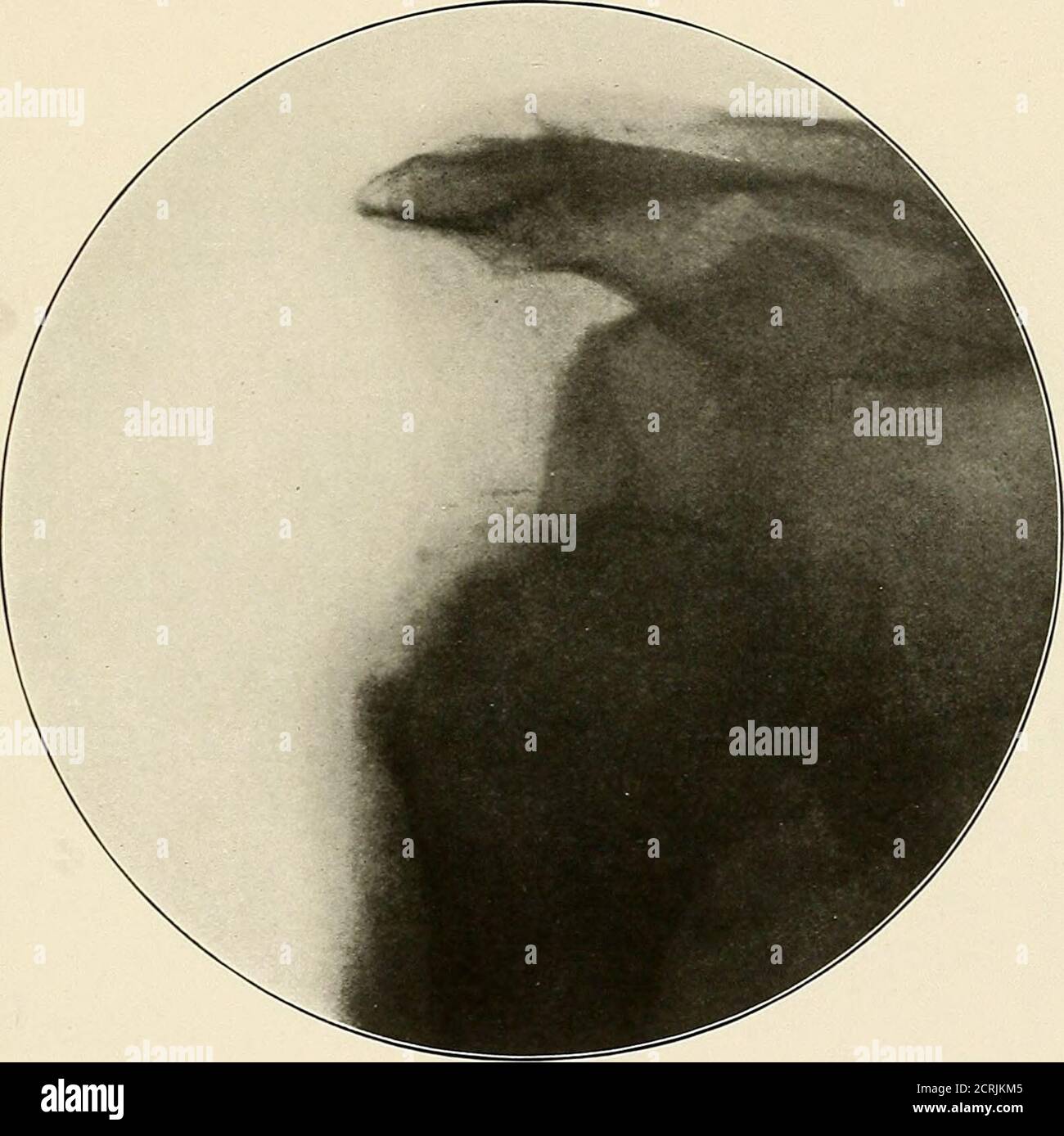 Congenital dislocation of the hips hi-res stock photography and images ...