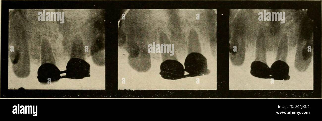. Elementary and dental radiography / by Howard Riley Raper . Fig. 146 ...