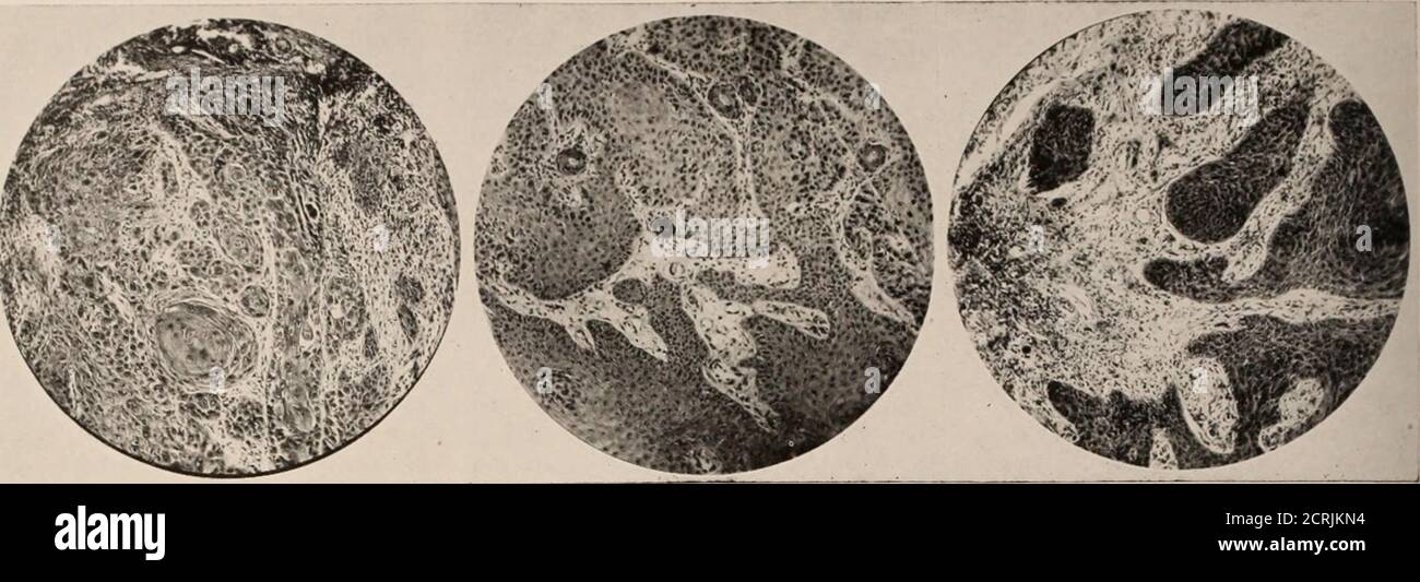 . Journal of radiology . Figure VI.—Radium pack; two mm.brass ...