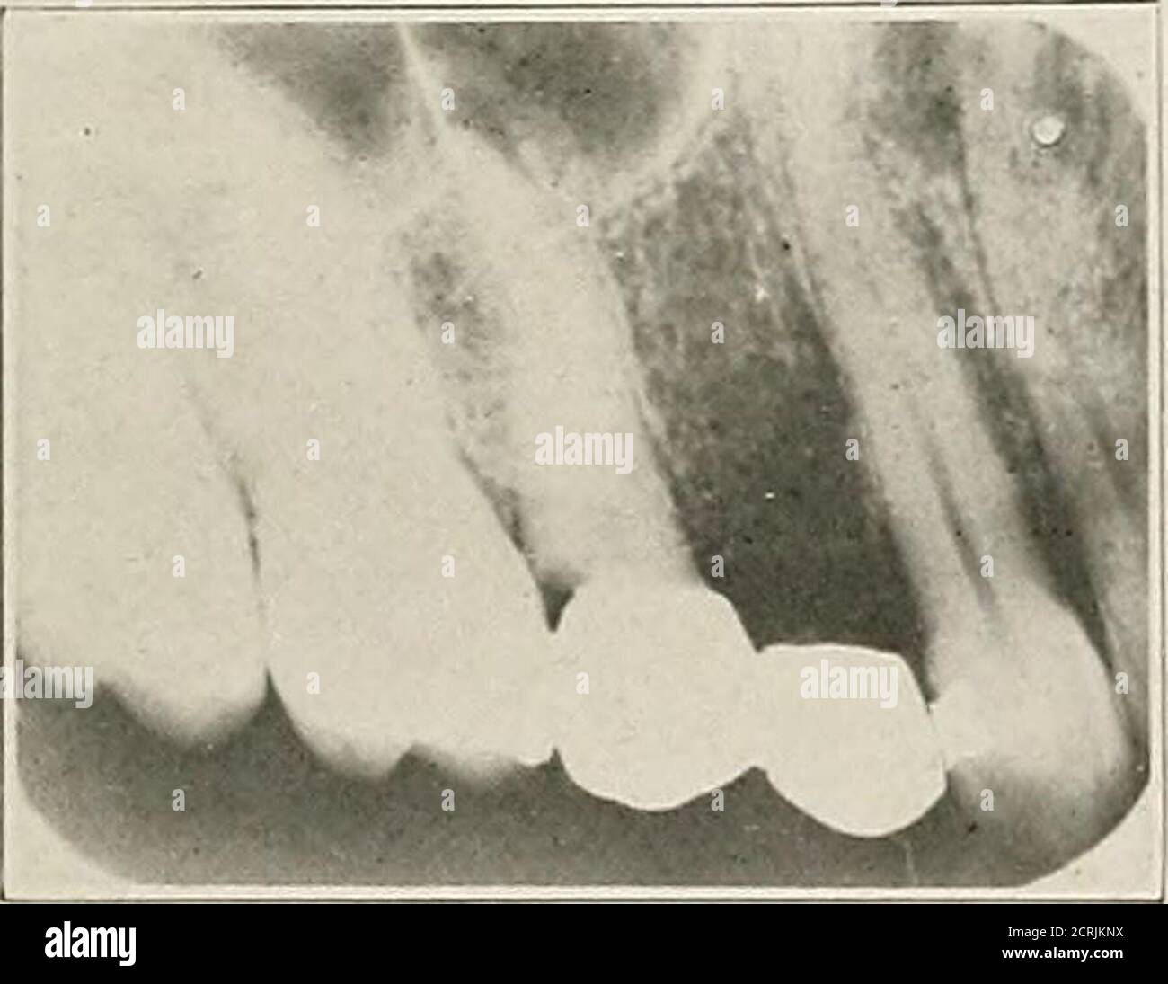 . Interpretation of dental and maxillary roentgenograms . Fig. 150. Fig ...