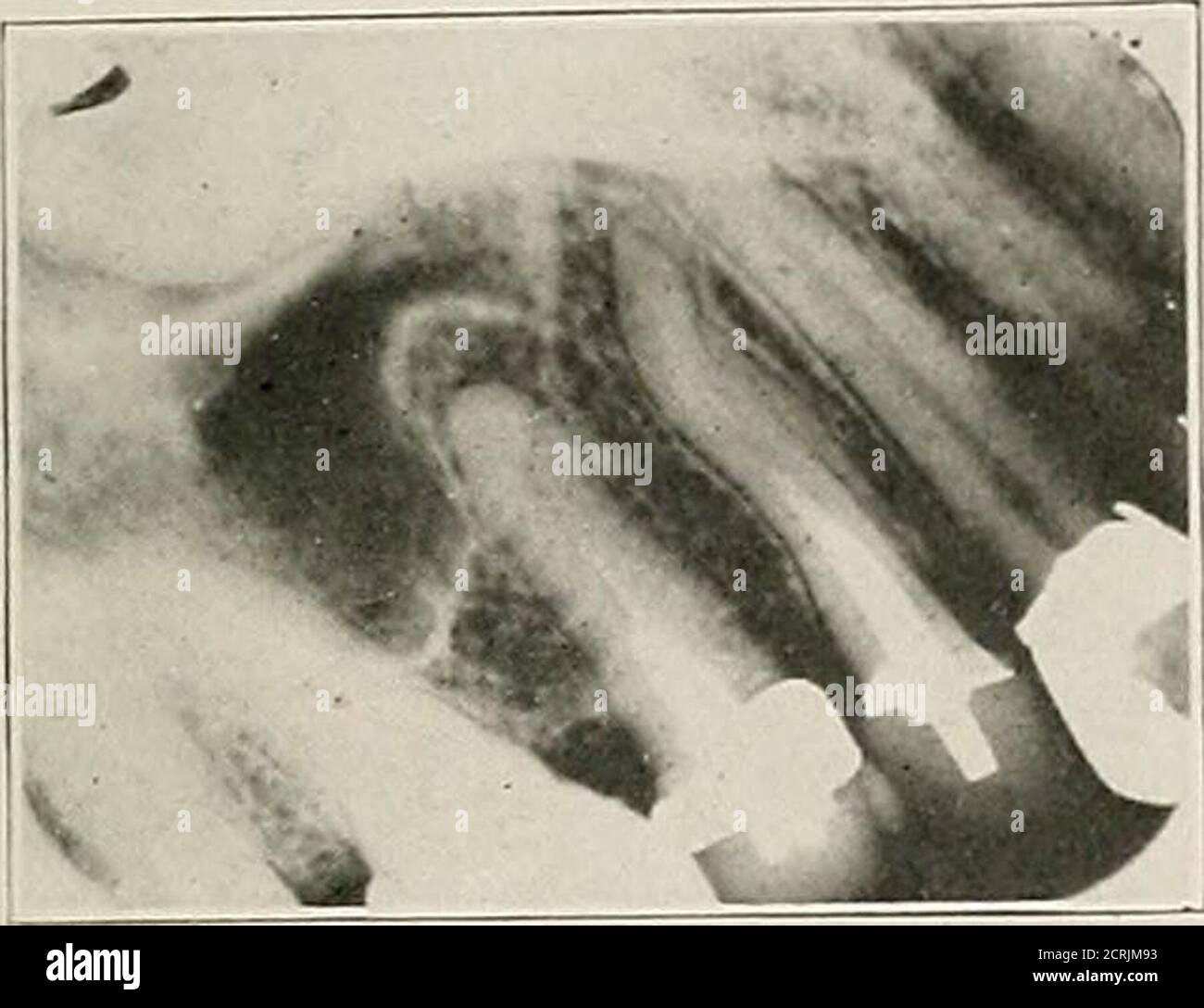 . Interpretation of dental and maxillary roentgenograms . Fig. 148. Fig ...