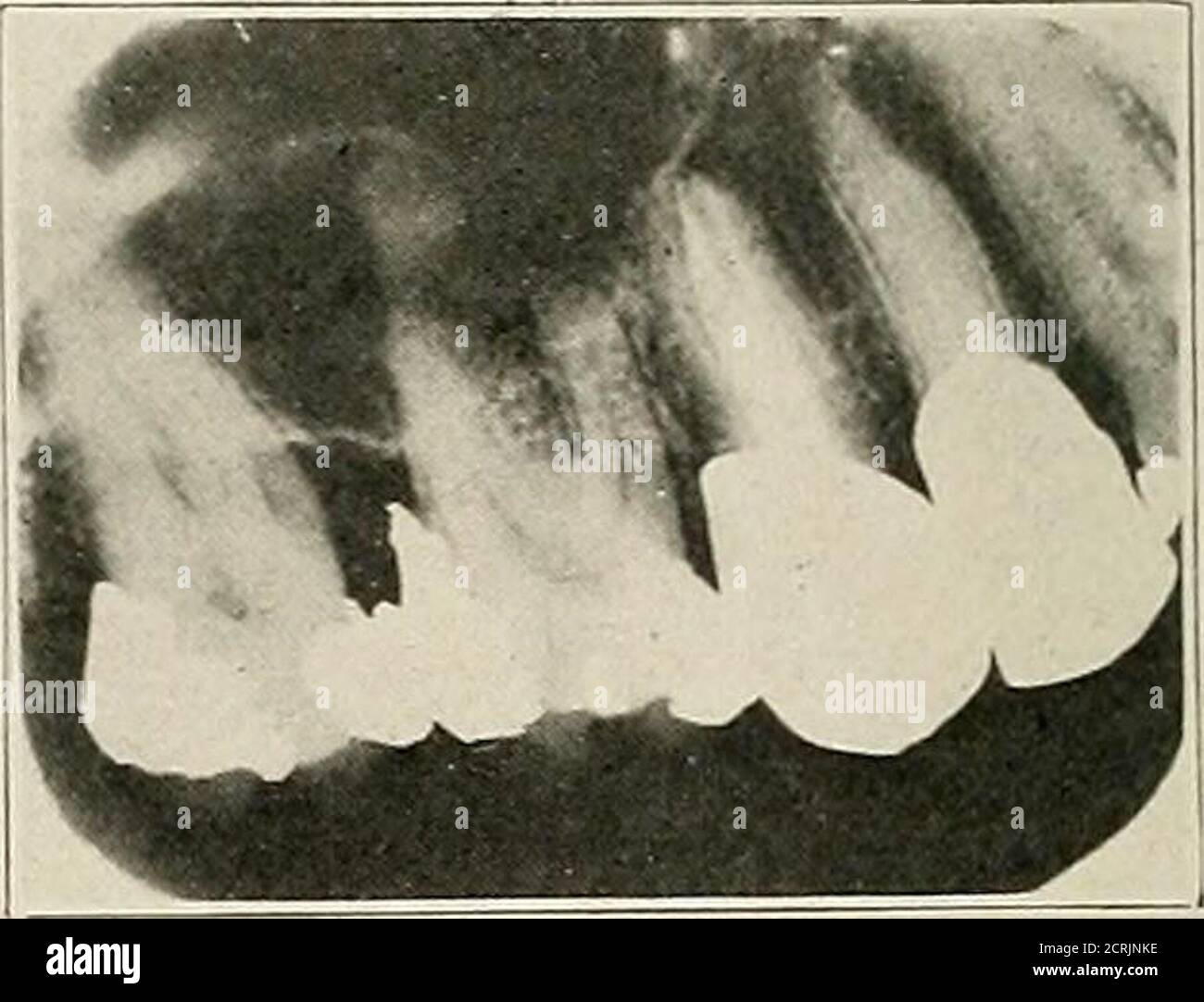 . Interpretation of dental and maxillary roentgenograms . Fig. 136. Fig ...