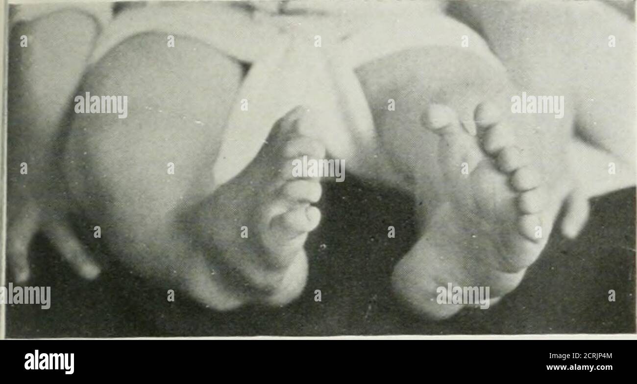 Congenital deformity of the hands hi-res stock photography and images ...