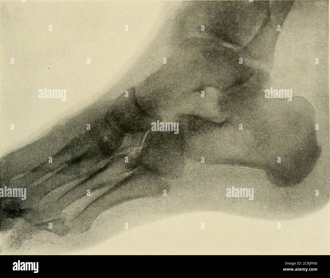 . Röntgen ray diagnosis and therapy . Fig. 231.—Fibroma of Fourth ...