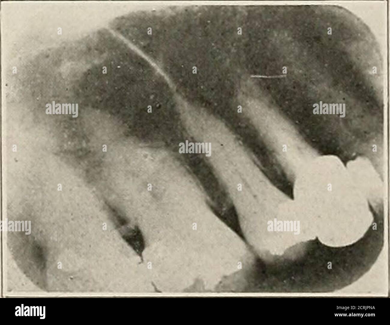 . Interpretation of dental and maxillary roentgenograms . Fig. 126. Fig ...