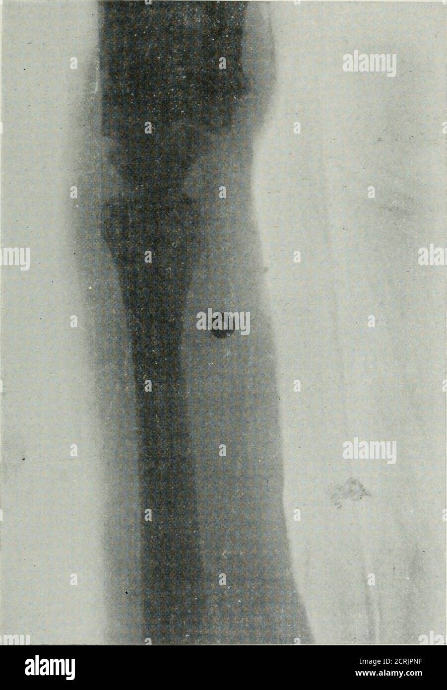 . The Roentgen rays in medicine and surgery as an aid in diagnosis and ...