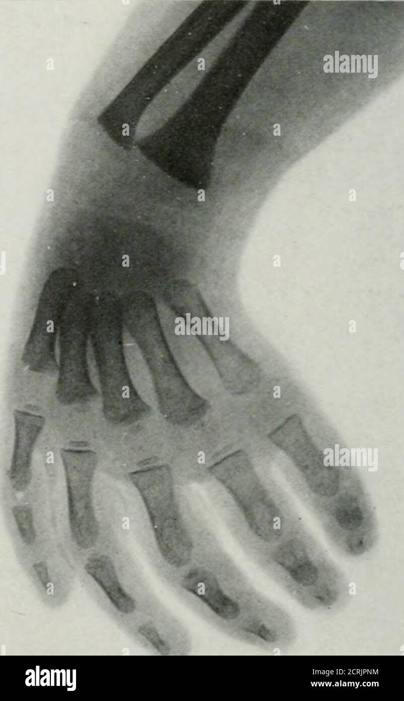 Deformity of the hands hi-res stock photography and images - Alamy