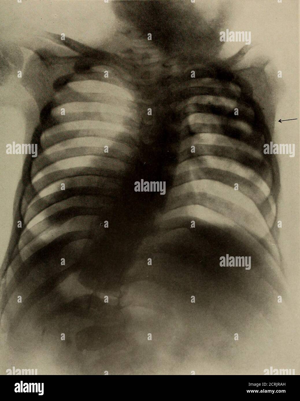 . Living anatomy and pathology; . r PLATE 114.UNRESOLVED LOBAR ...