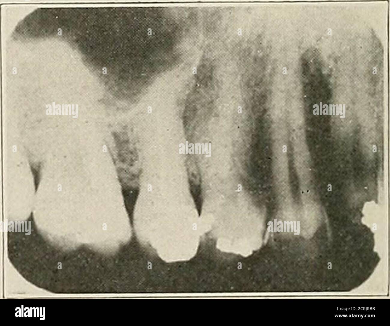 . Interpretation of dental and maxillary roentgenograms . Fig. 124. Fig ...