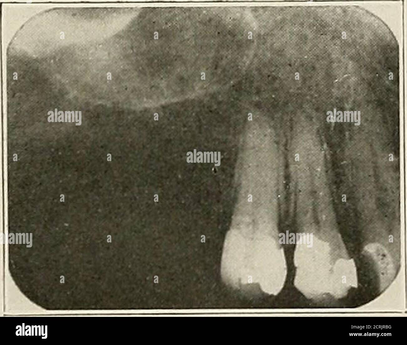 Maxillary first premolar hi-res stock photography and images - Alamy