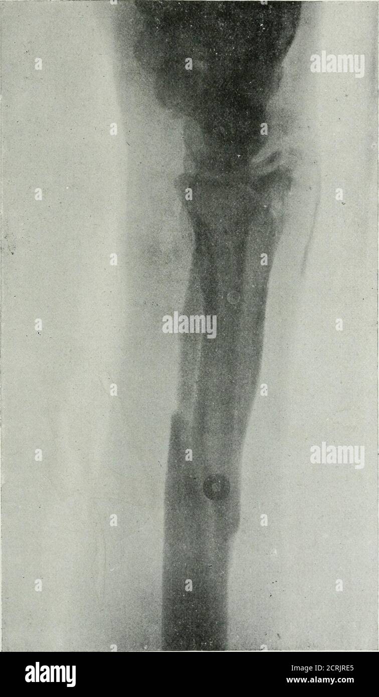 . The Roentgen rays in medicine and surgery as an aid in diagnosis and ...