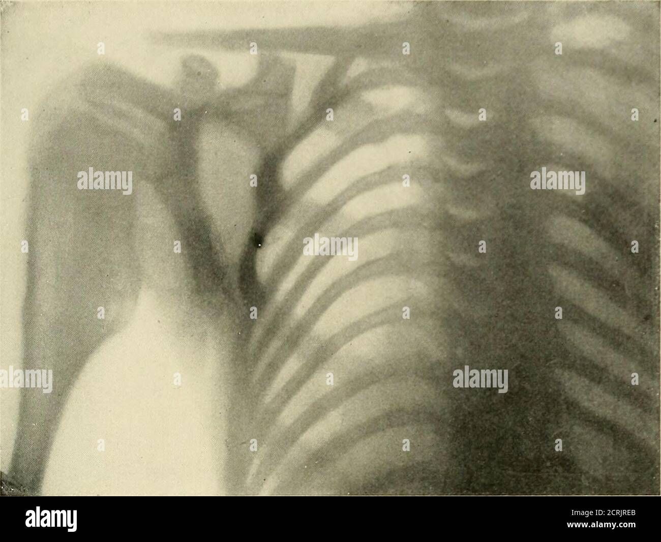. Röntgen ray diagnosis and therapy . Fig. 227.—Osteoma of Humerus ...